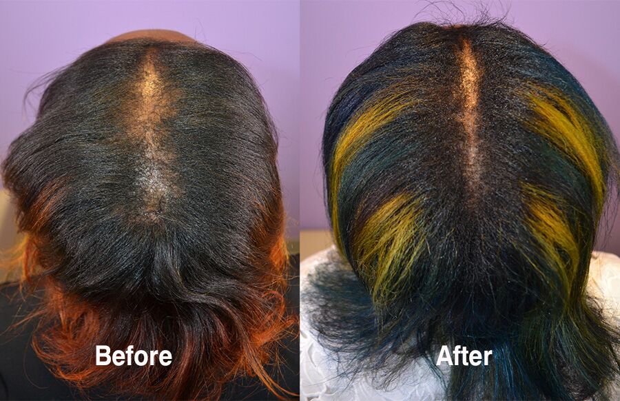 African American Female with Central Centrifugal Cicatricial Alopecia CCCA Hair Restoration of the South