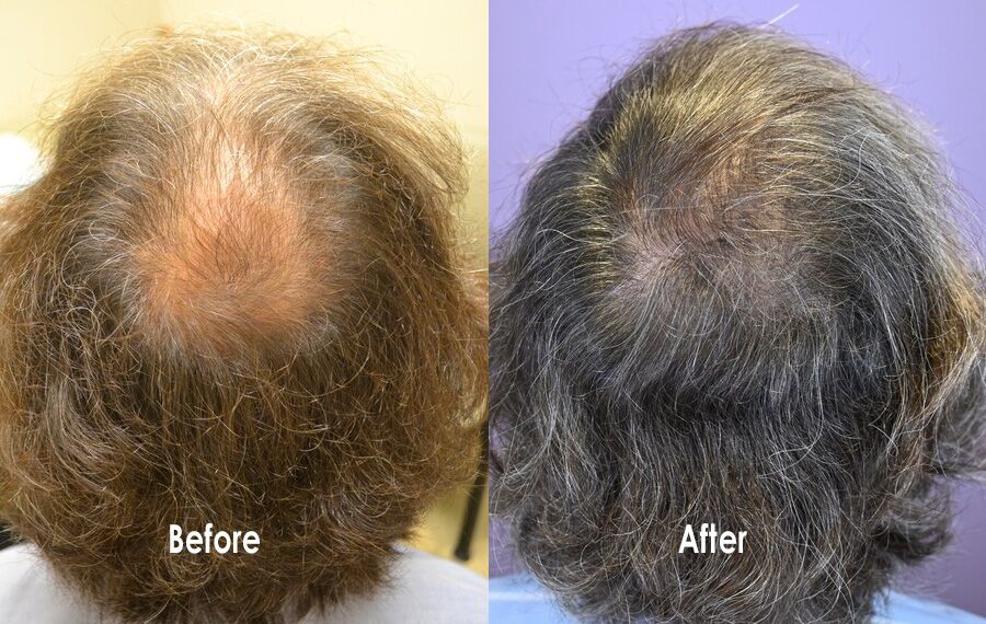 Duasteride For Treating Male Hair Loss Hair Restoration Of The South