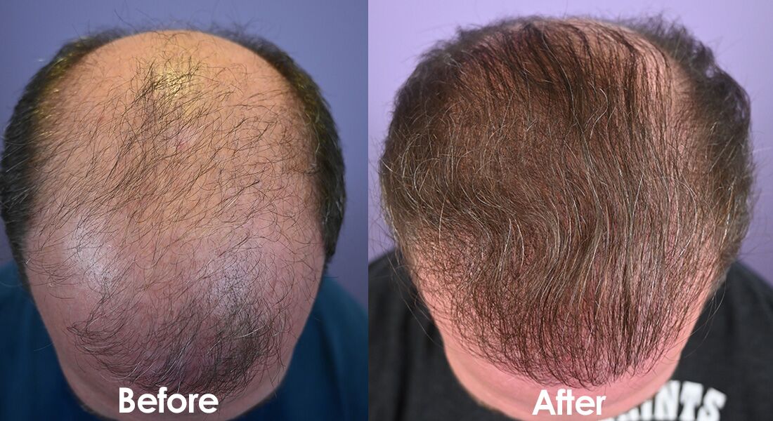 NW 6 Hair Loss - FUT Hair Transplant of Frontal Scalp - Hair ...